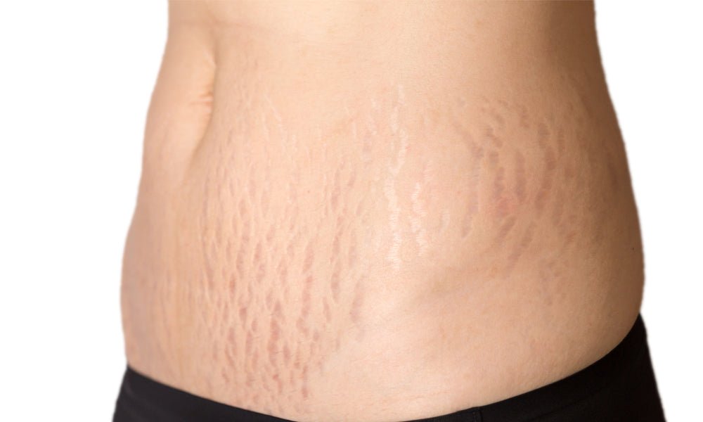 Scar and Stretch Mark Removal – Myers Dermatology & Clinical Spa