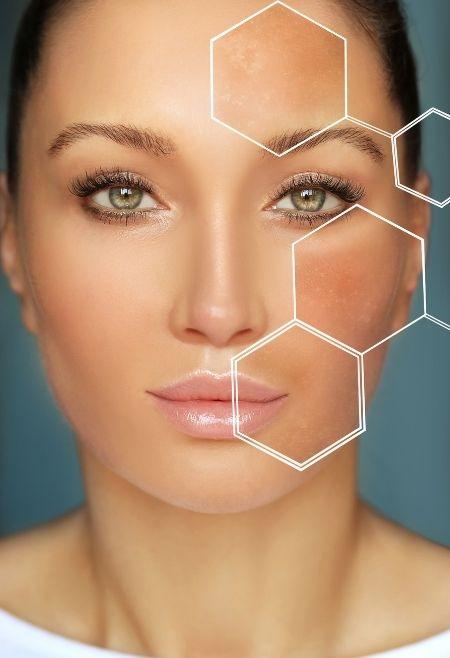 Skin discoloration – Myers Dermatology & Clinical Spa